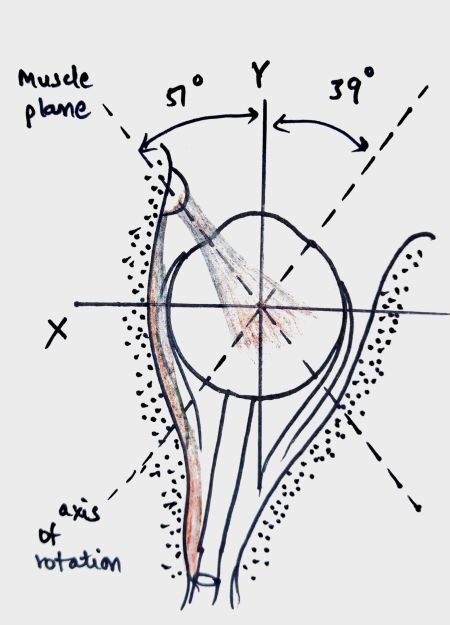 Strabismus Surgery, Cyclovertical - EyeWiki
