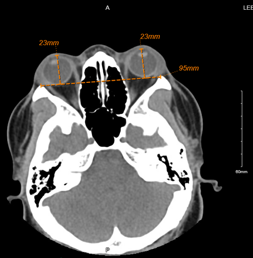 Exophthalmometry - EyeWiki