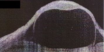 Conjunctival Inclusion Cyst - EyeWiki
