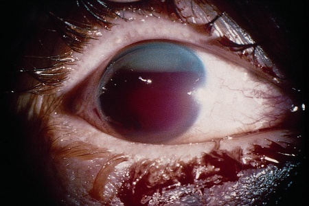 Pre-Ophthalmologist Management of Eye Trauma - EyeWiki