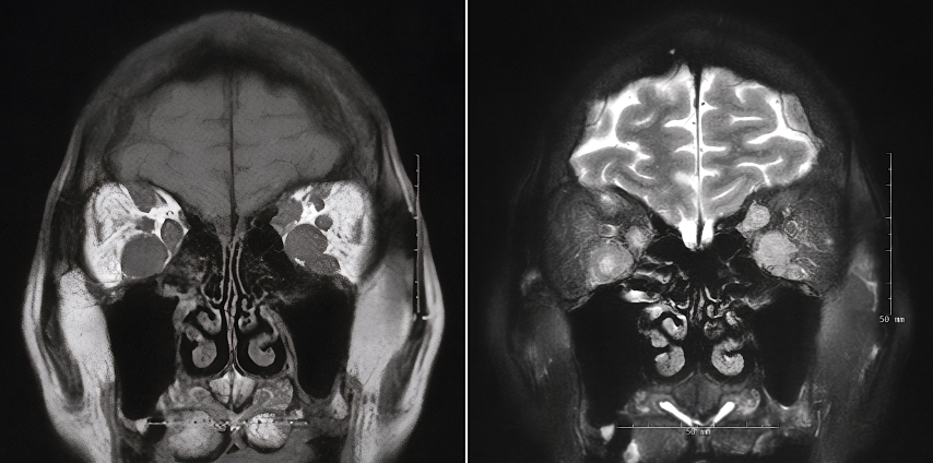 Metastasis to the Extraocular Muscles - EyeWiki