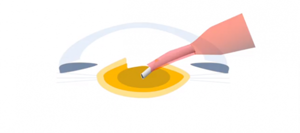 Vertical Chop Technique - EyeWiki