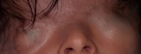 Cryptophthalmos - EyeWiki