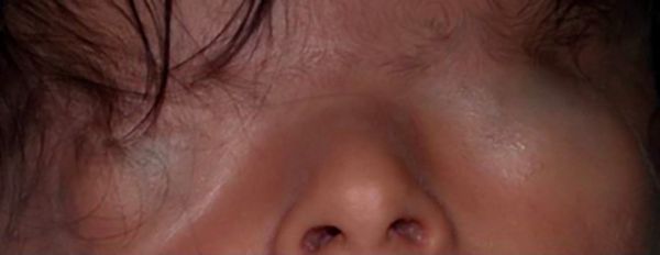 Cryptophthalmos - EyeWiki