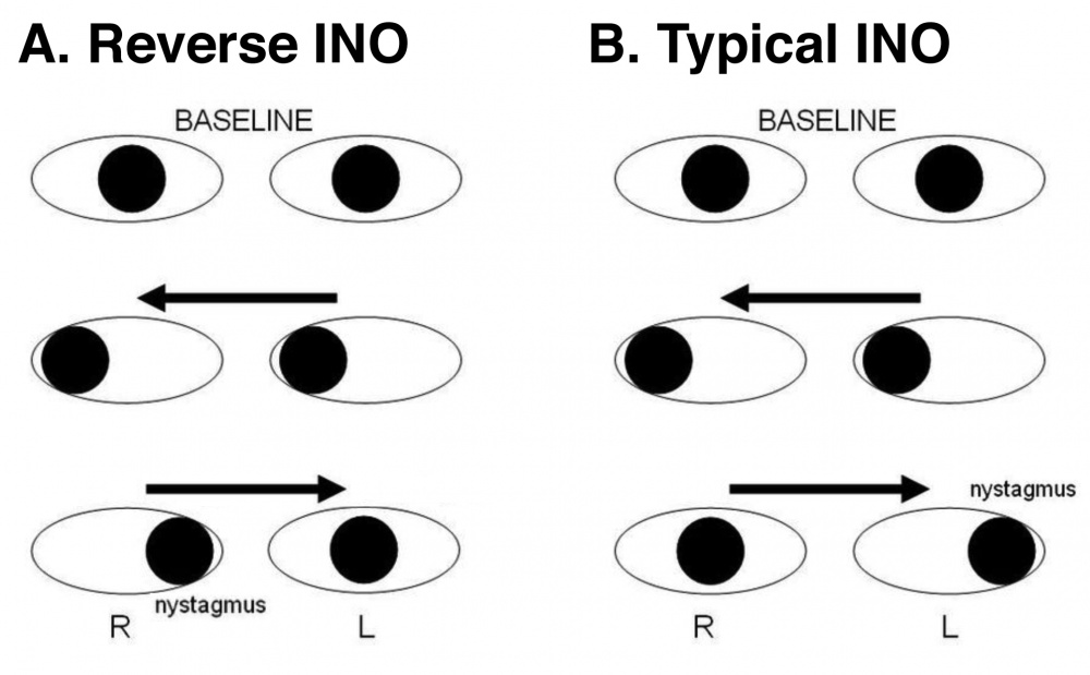 Internuclear Ophthalmoplegia of Abduction (Lutz Posterior INO) - EyeWiki