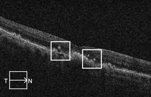 Age-Related Macular Degeneration - EyeWiki