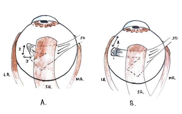 Strabismus Surgery, Cyclovertical - EyeWiki