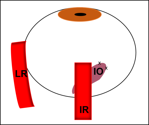 Strabismus Surgery, Cyclovertical - EyeWiki