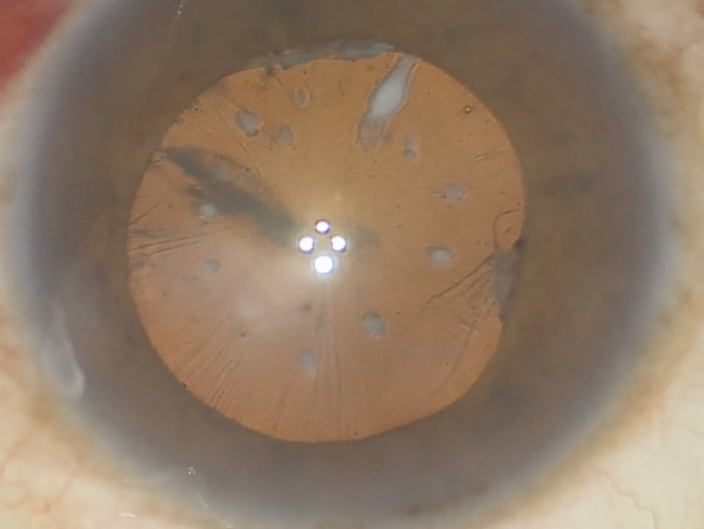 Long Anterior Zonules - EyeWiki