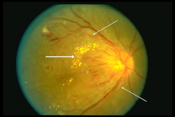 Hypertensive Retinopathy - EyeWiki