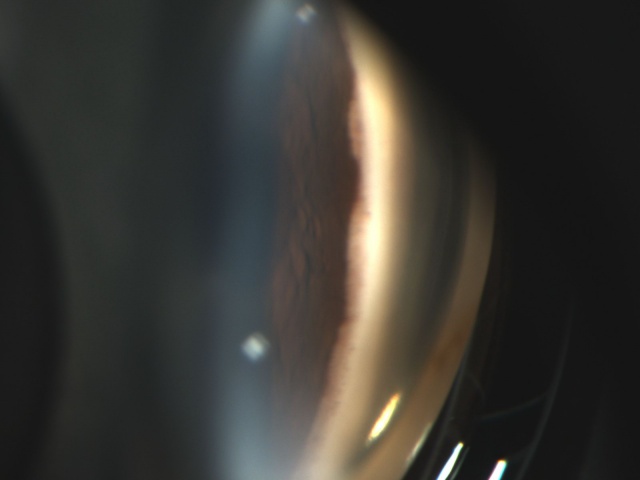 Primary vs. Secondary Angle Closure Glaucoma - EyeWiki