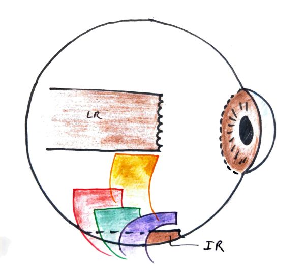 Strabismus Surgery, Cyclovertical - EyeWiki