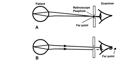Retinoscopy - EyeWiki
