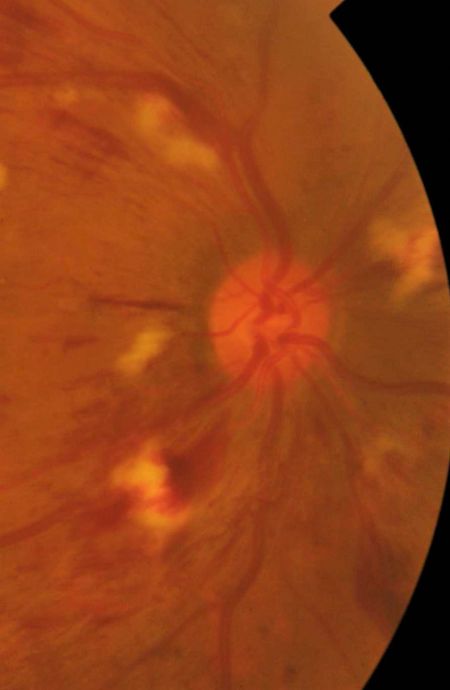 Retinal Manifestations of Leukemia - Leukemic Retinopathy - EyeWiki