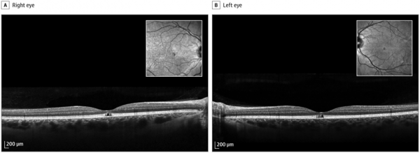Drug Induced Maculopathy - EyeWiki