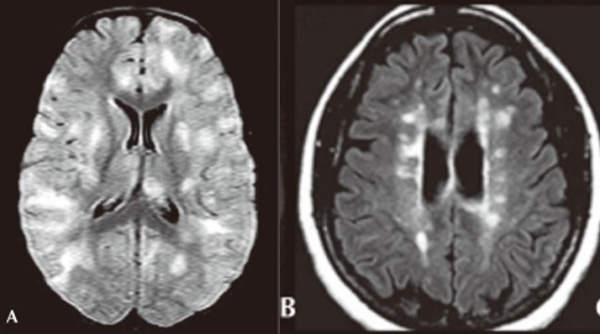 Acute Disseminated Encephalomyelitis - EyeWiki