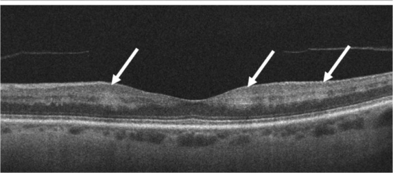 Optical Coherence Tomography - EyeWiki
