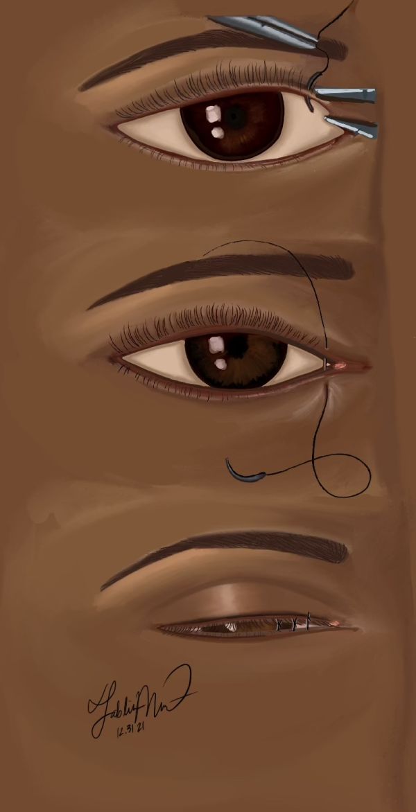 Tarsorrhaphy - EyeWiki