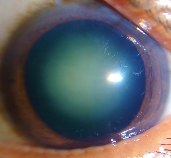 Cataract - EyeWiki