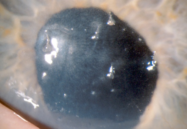 Filamentary Keratitis - EyeWiki