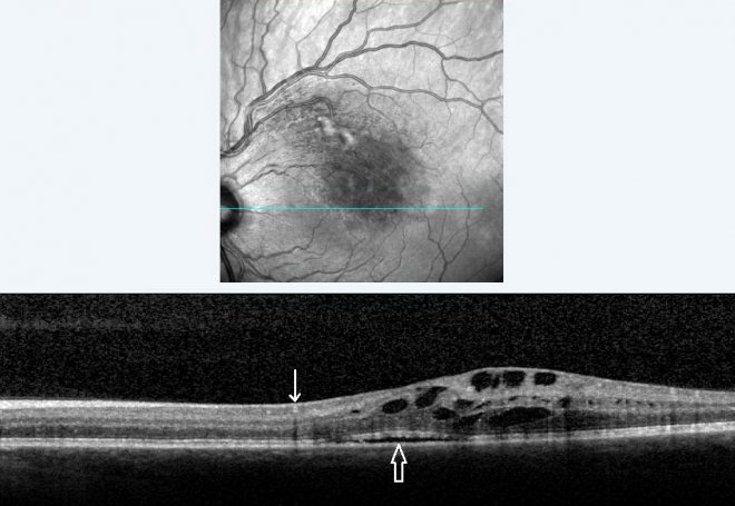 Branch Retinal Vein Occlusion - EyeWiki
