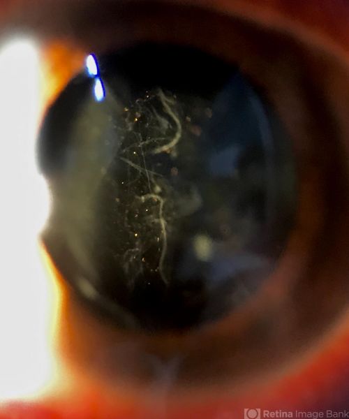 Retinal Detachment - EyeWiki