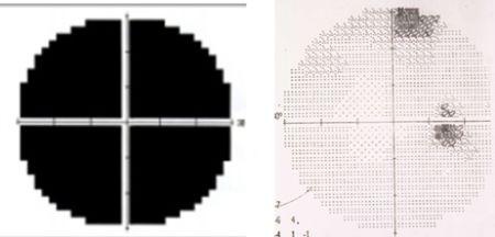 Compressive Visual Field Defects - EyeWiki