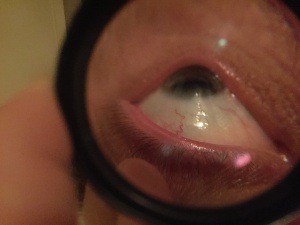 Keratoconus - EyeWiki