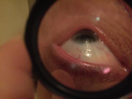 Keratoconus - EyeWiki