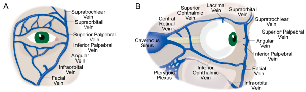 Superior Ophthalmic Vein Cannulation for Treatment of Cavernous Sinus ...