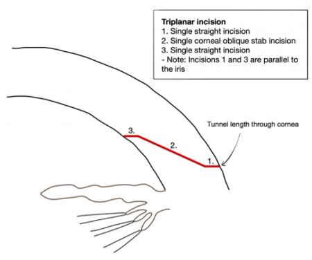 Incision Construction - EyeWiki