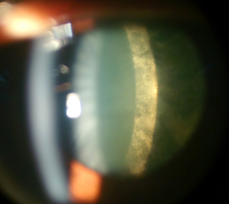 Cataract - EyeWiki