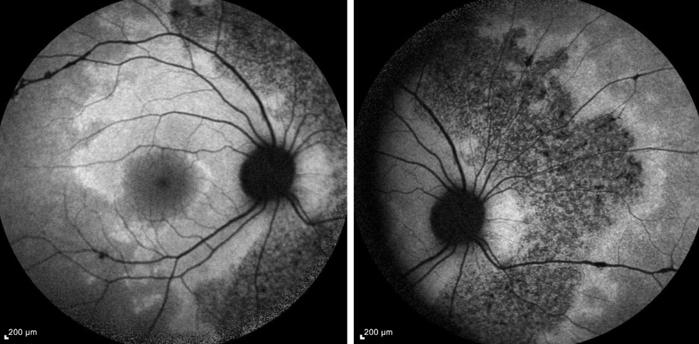 Pigmented Paravenous Retinochoroidal Atrophy - EyeWiki