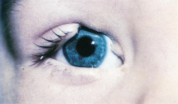 Coloboma - EyeWiki