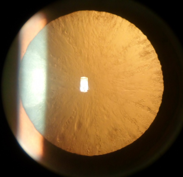 Cataract - EyeWiki