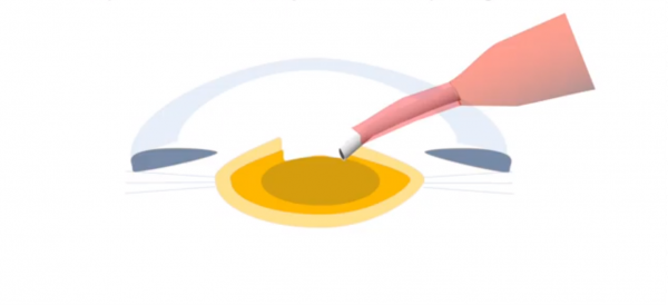 Vertical Chop Technique - EyeWiki