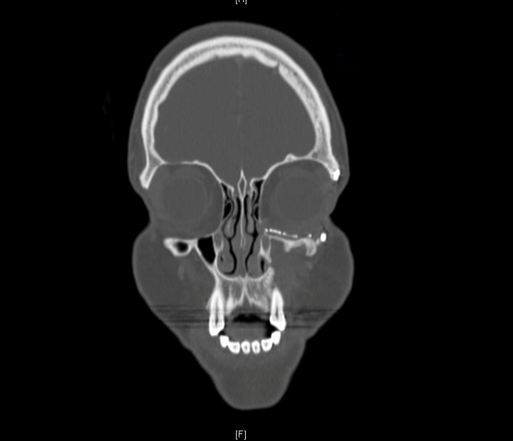Secondary Acquired Nasolacrimal Duct Obstruction - EyeWiki