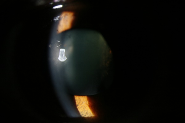 Microspherophakia - EyeWiki