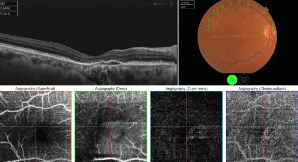 Choroidal Neovascularization: OCT Angiography Findings - EyeWiki