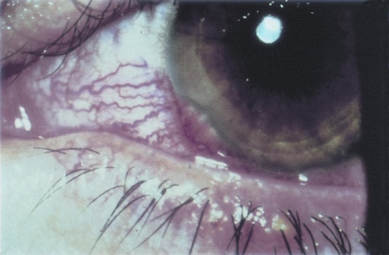 Blepharitis - EyeWiki