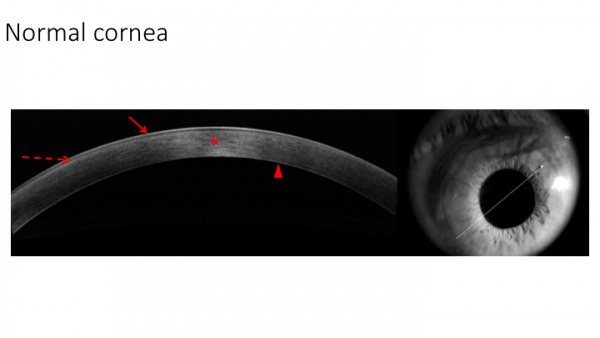Anterior Segment Optical Coherence Tomography for Various Ocular ...
