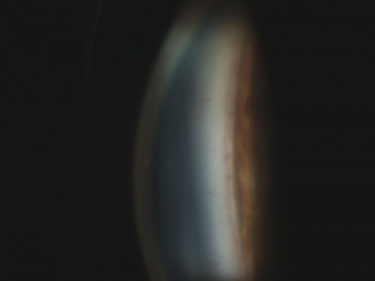 Fuchs Heterochromic Iridocyclitis - EyeWiki