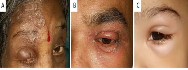 Approach to Generalized Eyelid Edema - EyeWiki