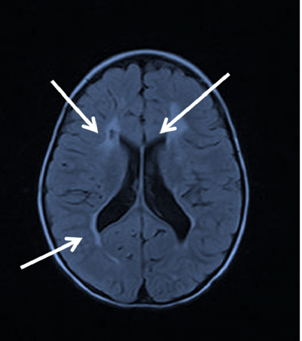 Neuro-ophthalmic Manifestations in Adults after Childhood ...