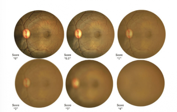 Intermediate Uveitis - EyeWiki
