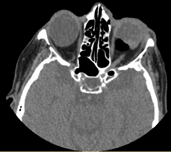Ocular Trauma: Acute Evaluation, Cataract, Glaucoma - EyeWiki