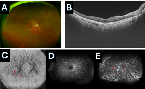 Choroidal Vascular Anomalies: Posterior Vortex Veins, Choroidal ...