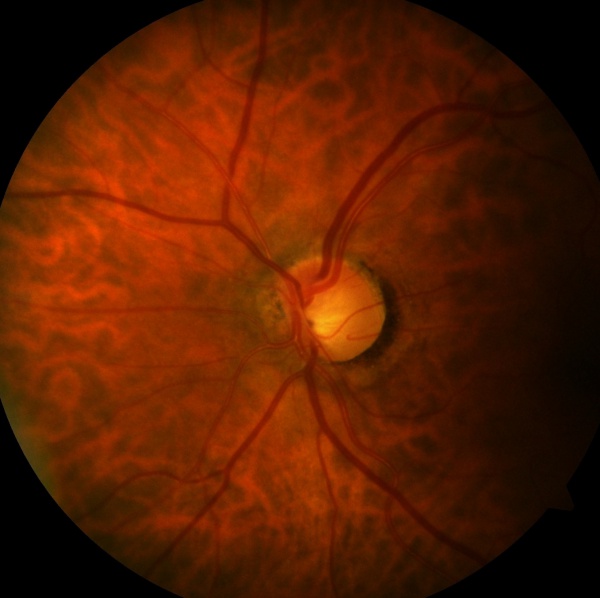 Tilted Disc Syndrome - EyeWiki