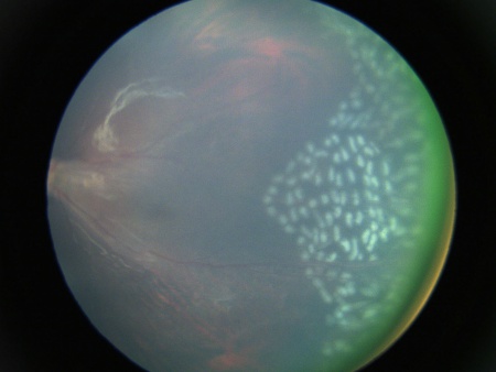 Familial Exudative Vitreoretinopathy (FEVR) - EyeWiki
