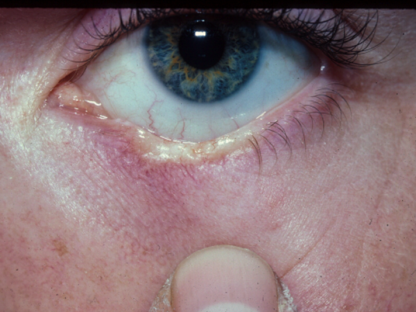 Hughes Procedure - EyeWiki